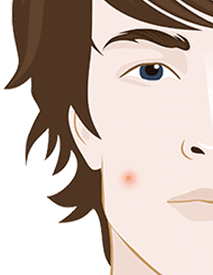 Bölder kräver behandling → Se vad du ska göra här